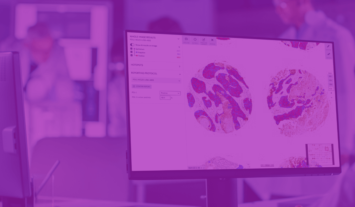 First NHS Trust has signed a contract to adopt Aiforia PD-L1 AI model ... First NHS Trust has signed a contract to adopt Aiforia PD-L1 AI model ...